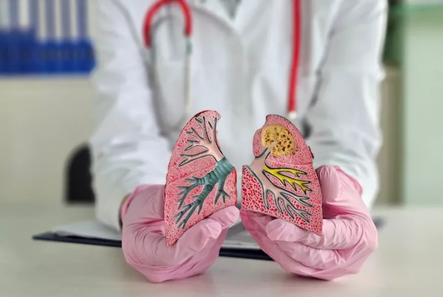 Guide to Acute And Chronic Bronchitis