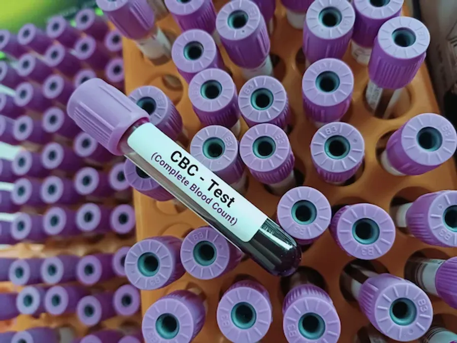 Your Complete Guide to the CBC Test: Understanding Your Blood Count Results