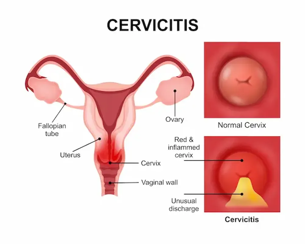 cervicitis uk