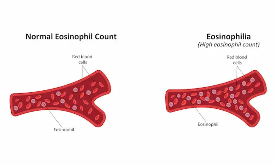 Understanding Eosinophilia: Symptoms, Causes, and Treatment | Apollo