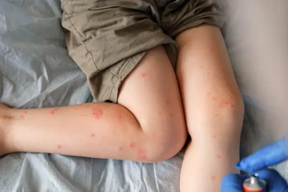 stooped posture in chikungunya