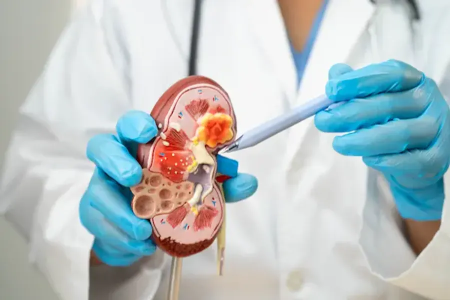 What Leads To Signs Of Kidney Stone And Types