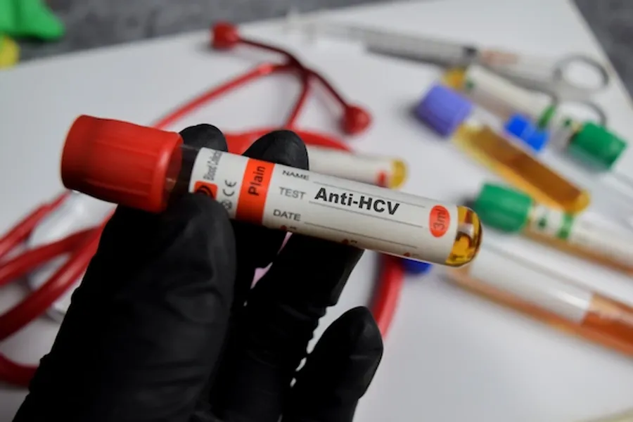 Anti-HCV Test: Understanding Normal Range and Results