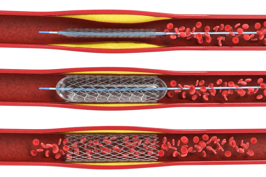 How Long Does It Take To Do An Angioplasty?