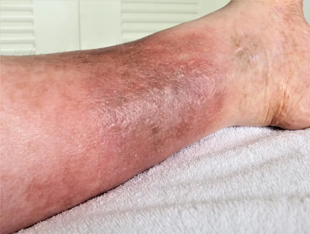 cellulitis symptoms