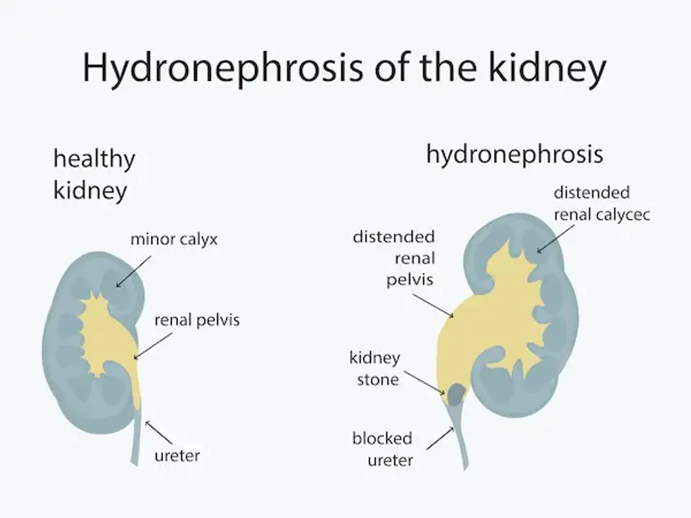 minor hydronephrosis
