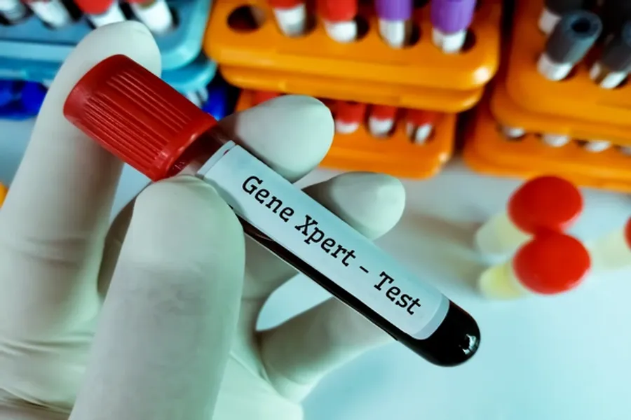 GeneXpert Test for TB Detection