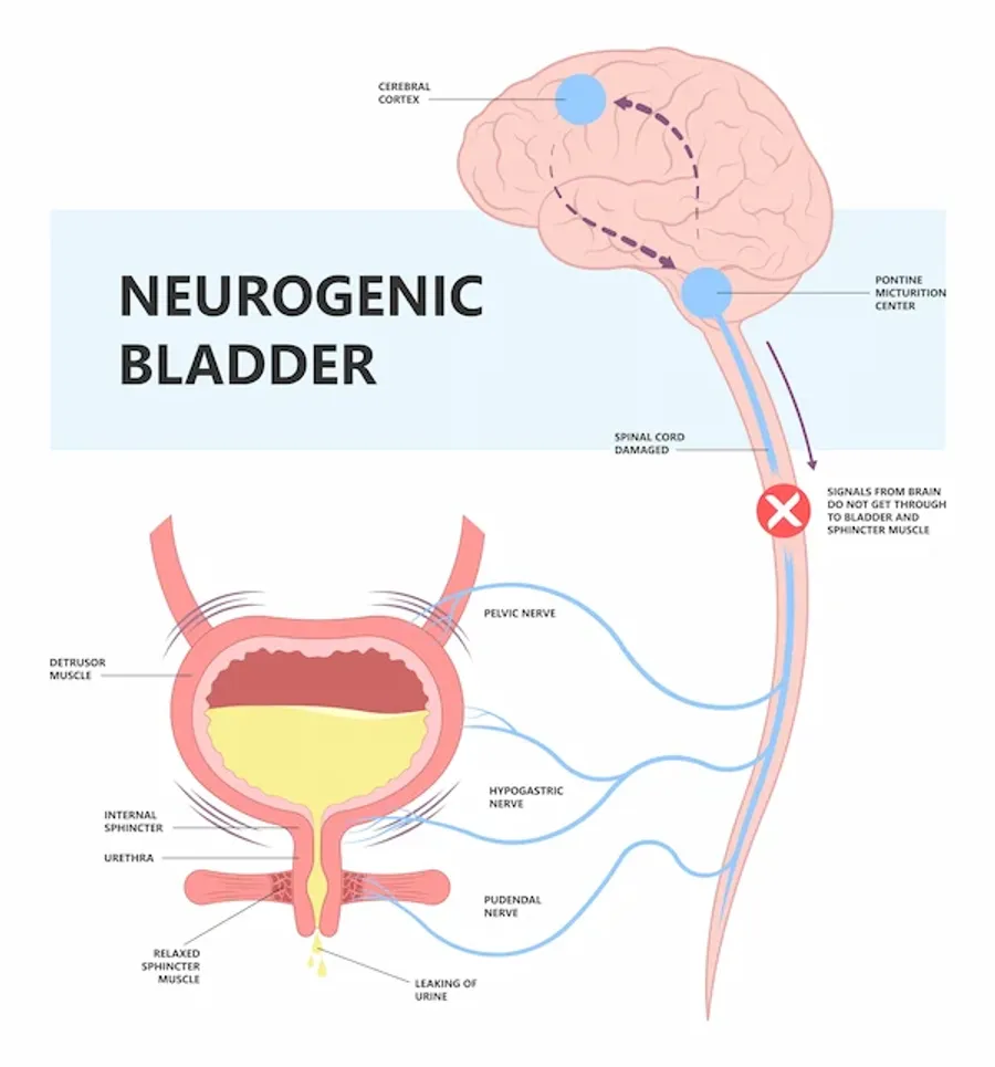 Neurogenic Bladder: Causes, Symptoms, and Management