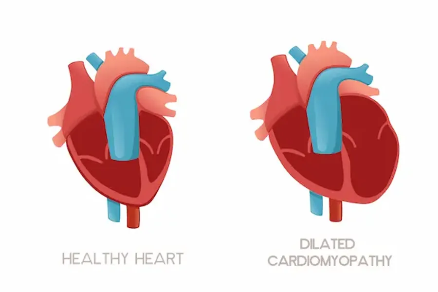 Understanding Dilated Cardiomyopathy: Causes, Symptoms, and Treatment