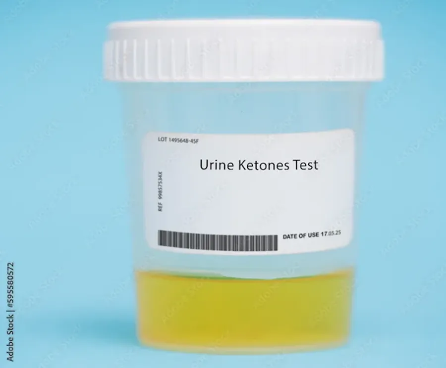 Ketones in Urine: Causes, Symptoms, and When to Worry