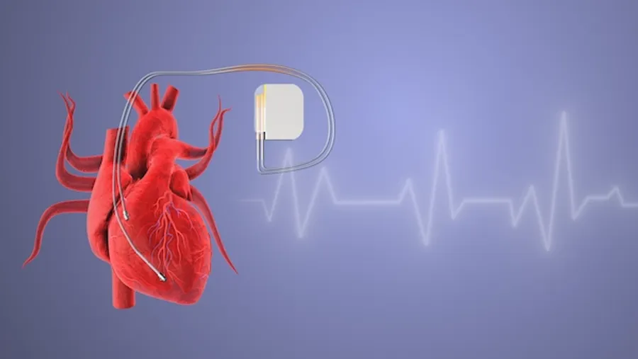 Your Guide to the Dos and Don’ts of Living with an ICD