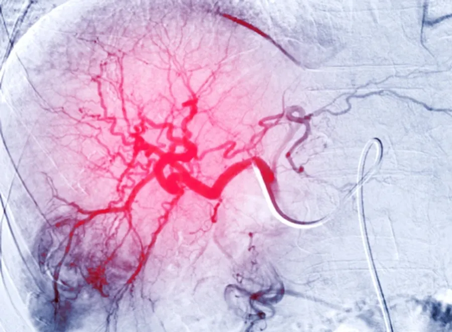 TACE Procedure: A Guide to Transarterial Chemoembolization