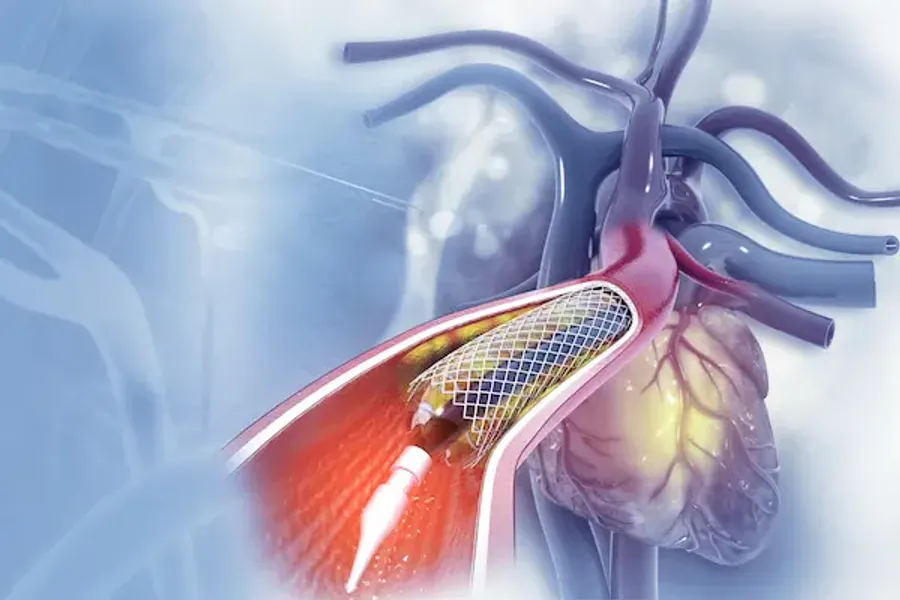 Complications After Angioplasty: What You Should Know