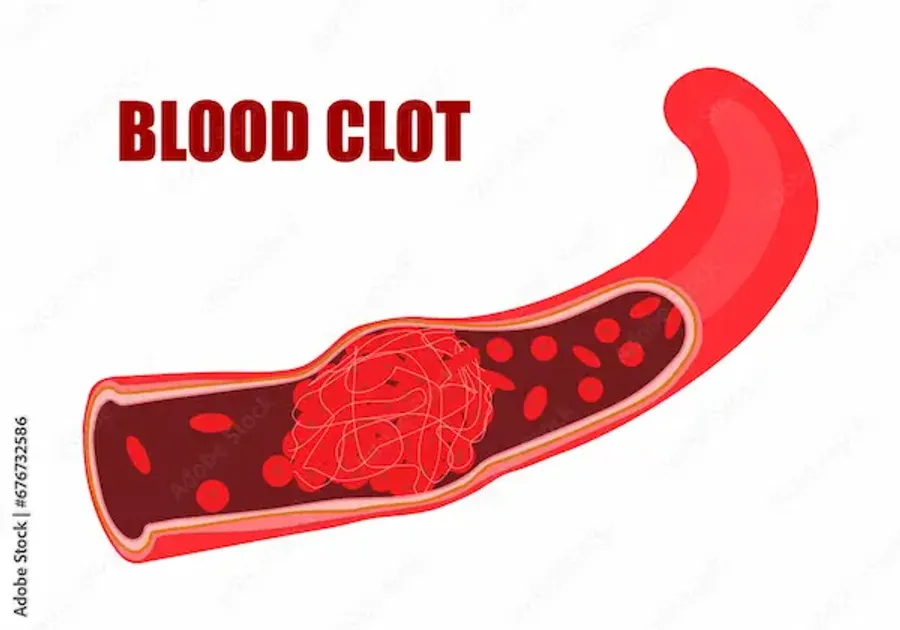 What Leads To Signs Of Blood Clot And