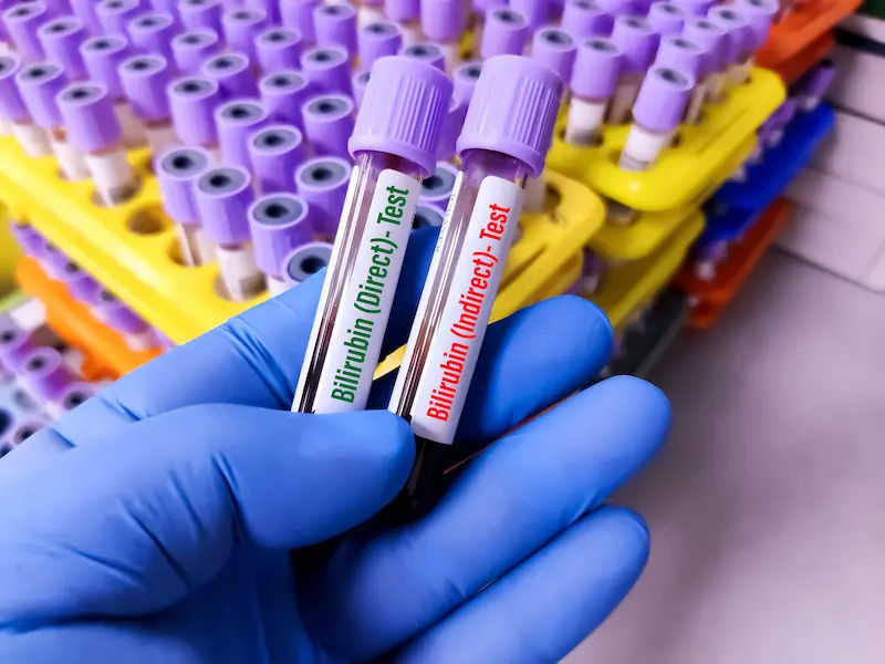 Bilirubin Test and Its Normal Range