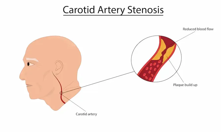 Carotid Revascularisation A Guide to Who Really Needs It