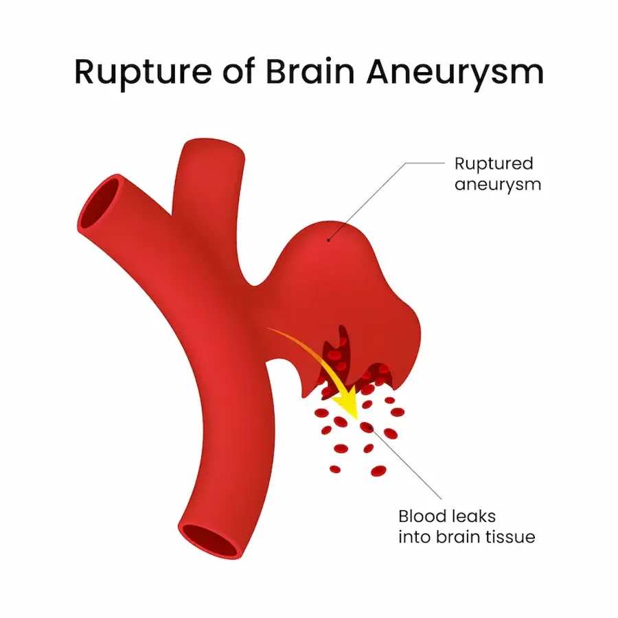 Cerebral Aneurysm Rupture Key Symptoms and Emergency Action