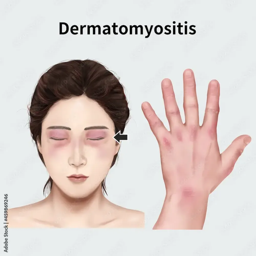 dermatomyositis causes