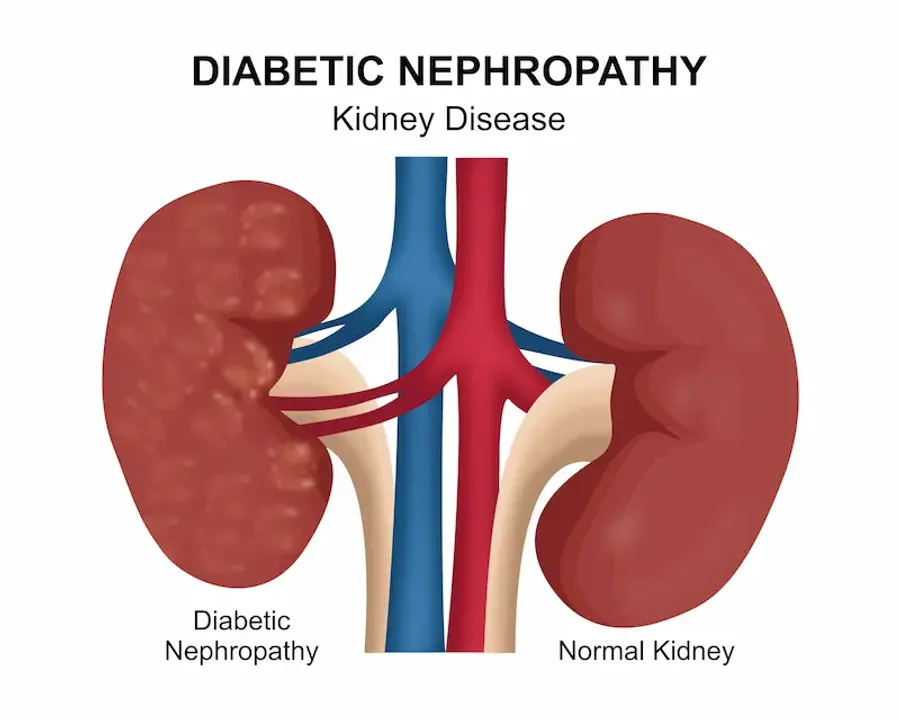 Guide to Diabetes Nephropathy Kidney Disease