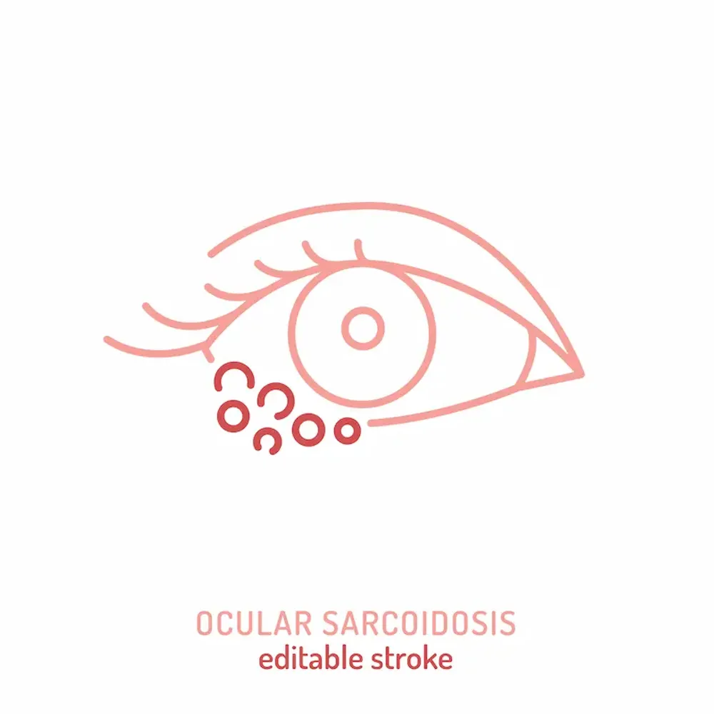 sarcoidosis eye symptoms