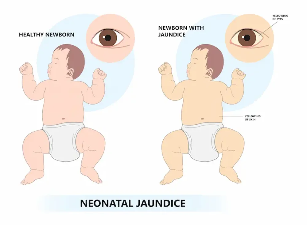 yellow jaundice in premature babies