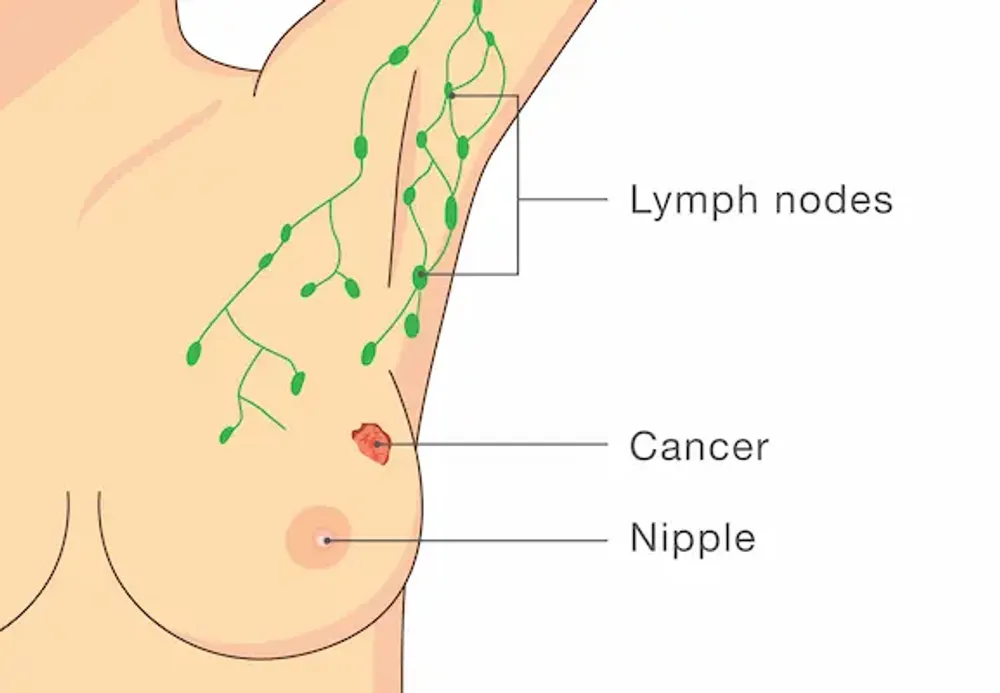 lymph node armpit swelling