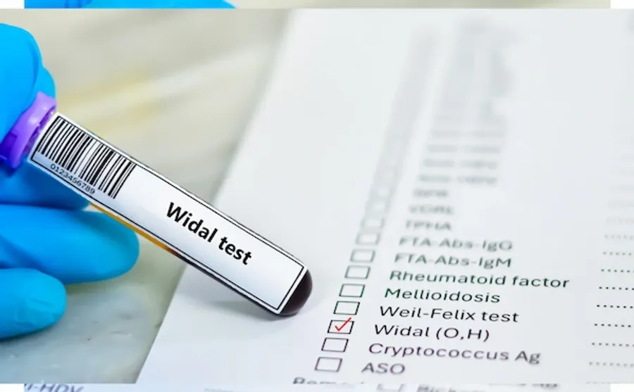 Typhoid Test Names and Details