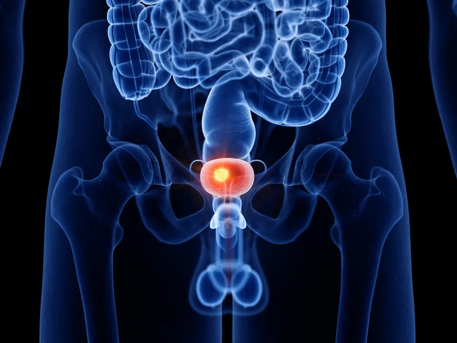 Urinary Tract Cancer Symptoms Overview
