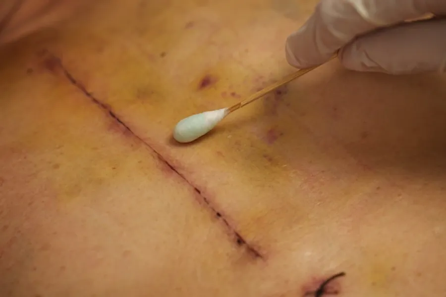 Healing Of Sternum After Bypass Surgery