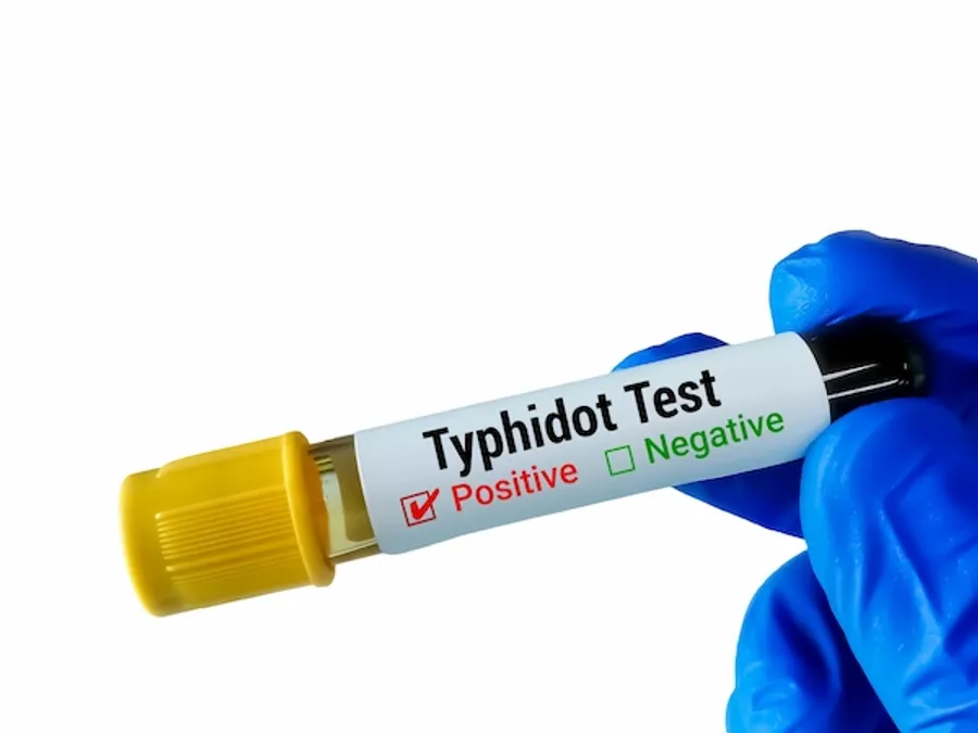 Checking Blood Tests for Typhoid