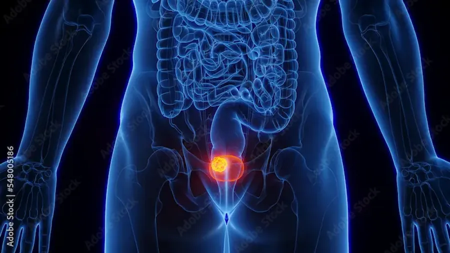 Early Signs of Urinary Bladder Cancer What to Watch and When to Act