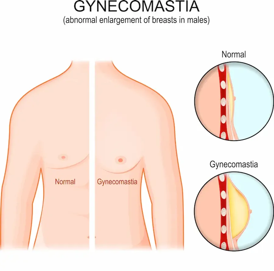 Gynecomastia Causes, Treatment, and What to Do