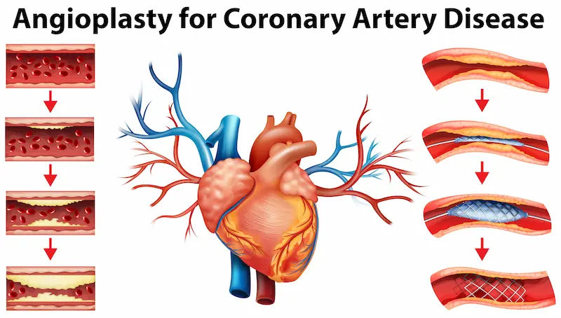 Complications After Angioplasty: What You Should Know