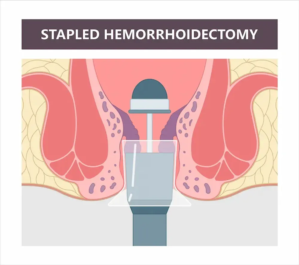 piles return after surgery