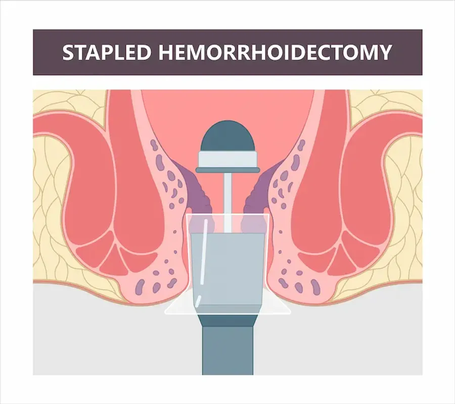 Laser Surgery for Piles Complete Guide for Faster Relief