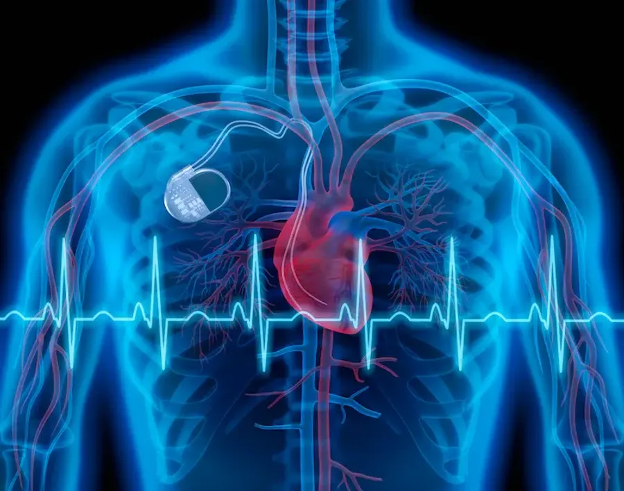 The Micra Pacemaker A Complete Guide to the World's Smallest Heart Device