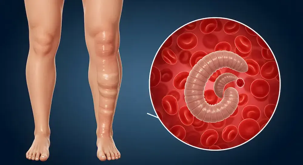 which worm causes elephantiasis