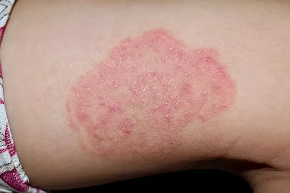 mild ringworm on arm