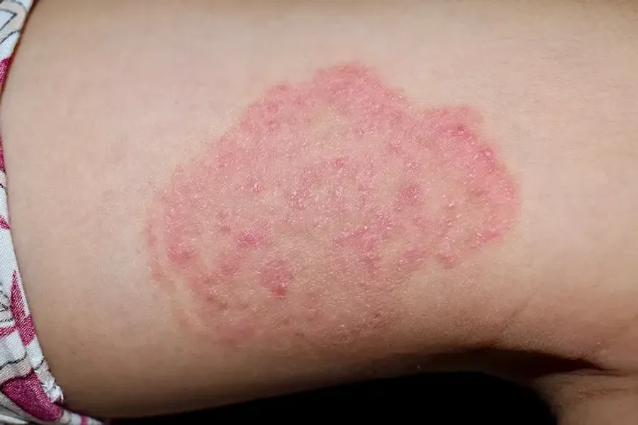 What Leads to Signs of Ringworm and Types – Causes, Symptoms & Treatment