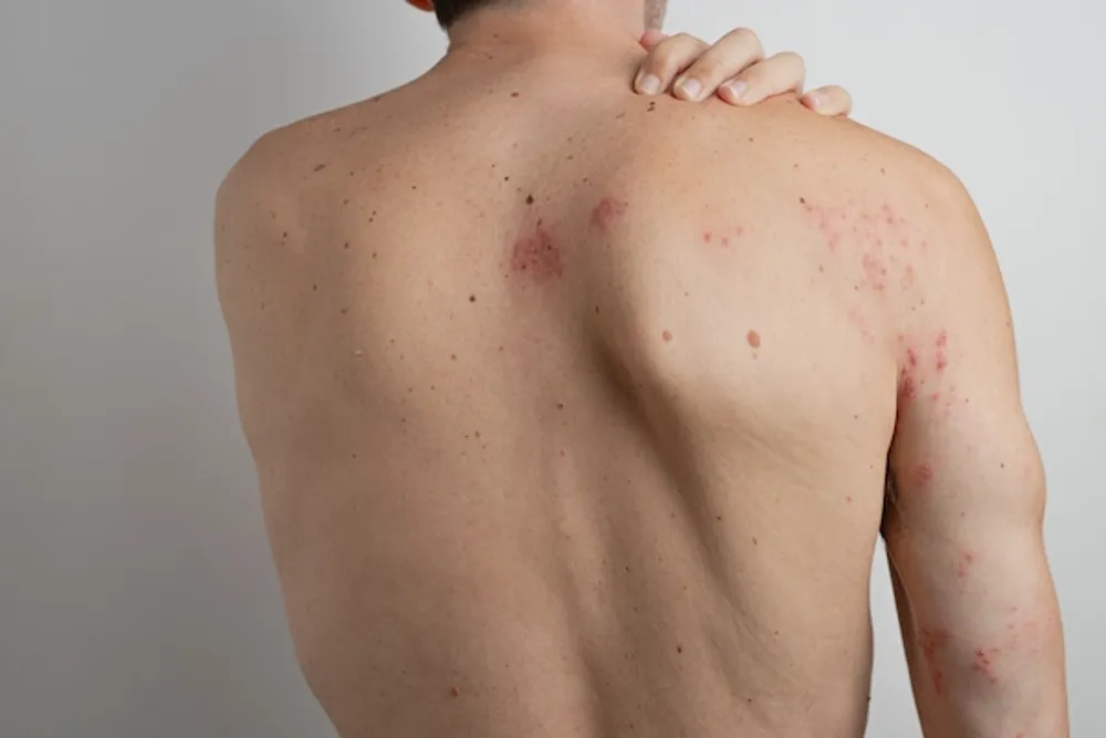 shingles back symptoms