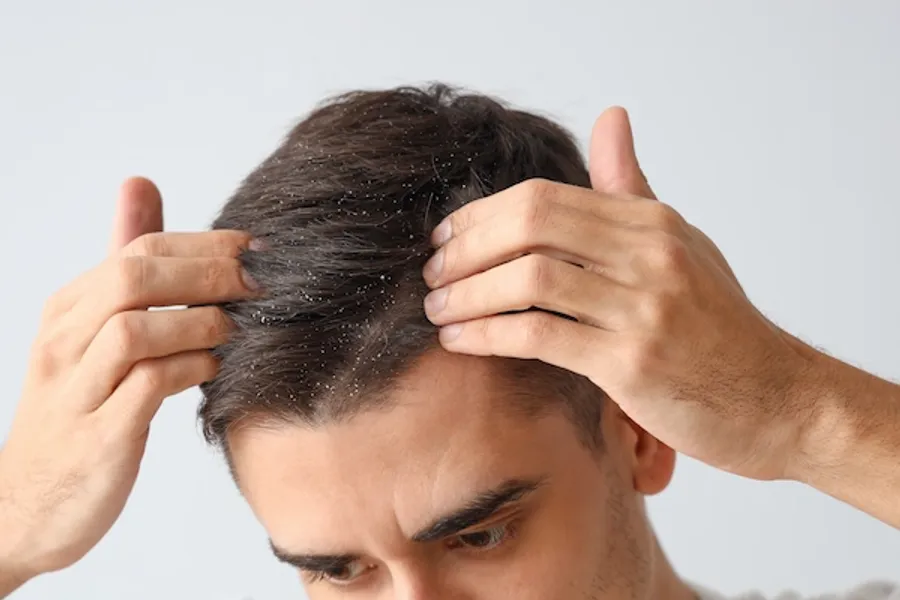 Proven Home Remedies to Get Rid of Dandruff Naturally