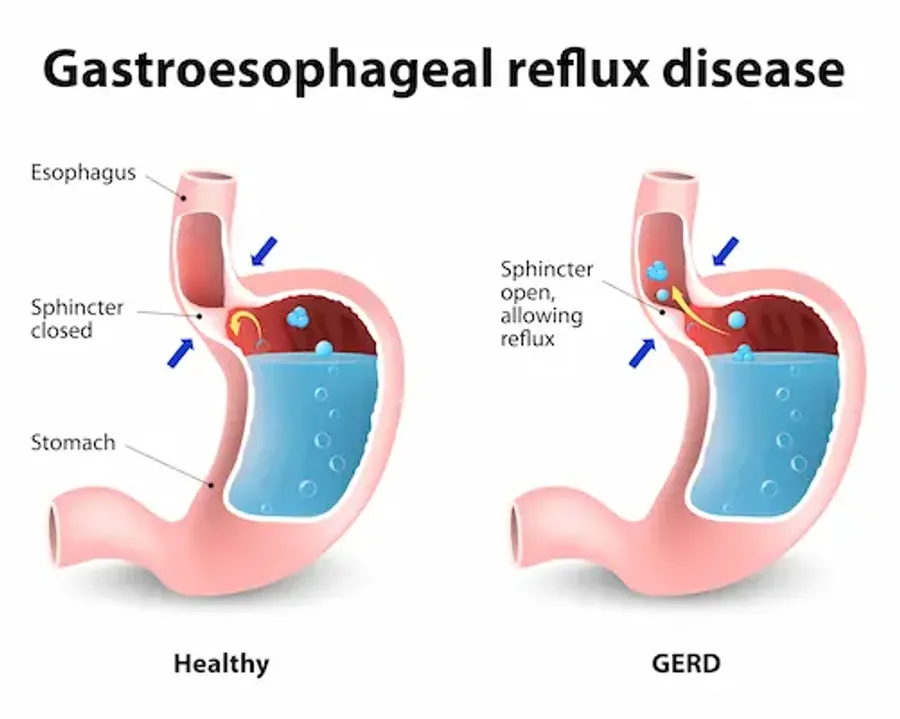 Understanding the Causes of GERD