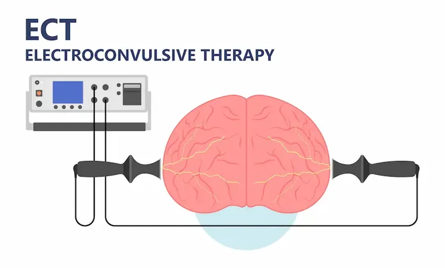 What is the Full Form of ECT?