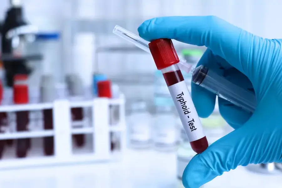 Types of Typhoid and Relevant Tests