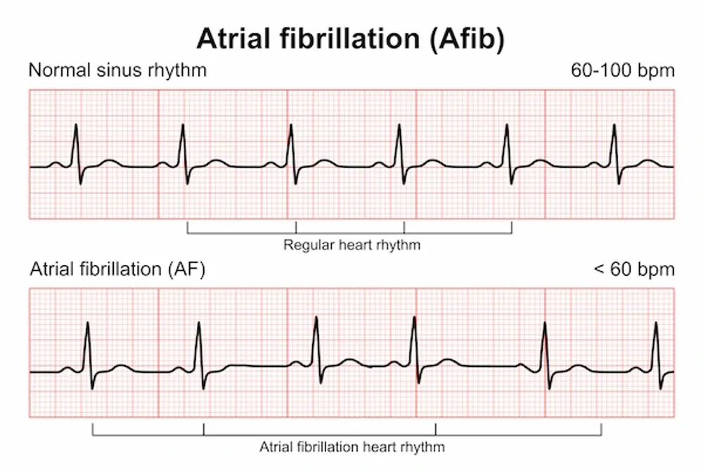 how does afib present