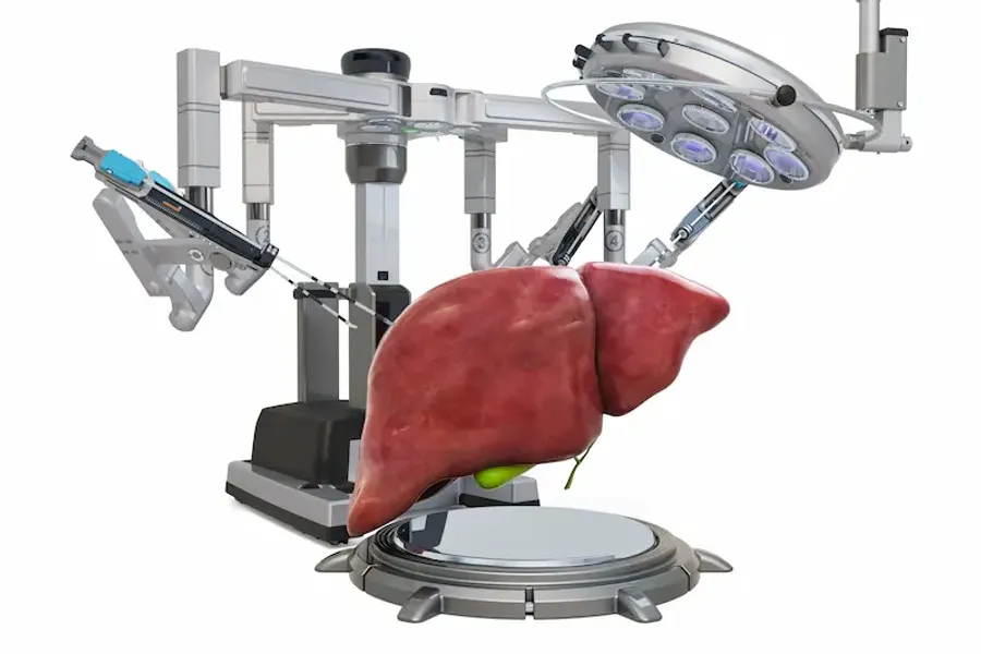 Your Guide to Robotic Gallbladder Surgery: Benefits, Risks & Recovery