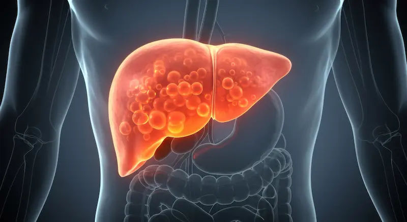 Fatty Liver Grade 2: Key Symptoms Explained