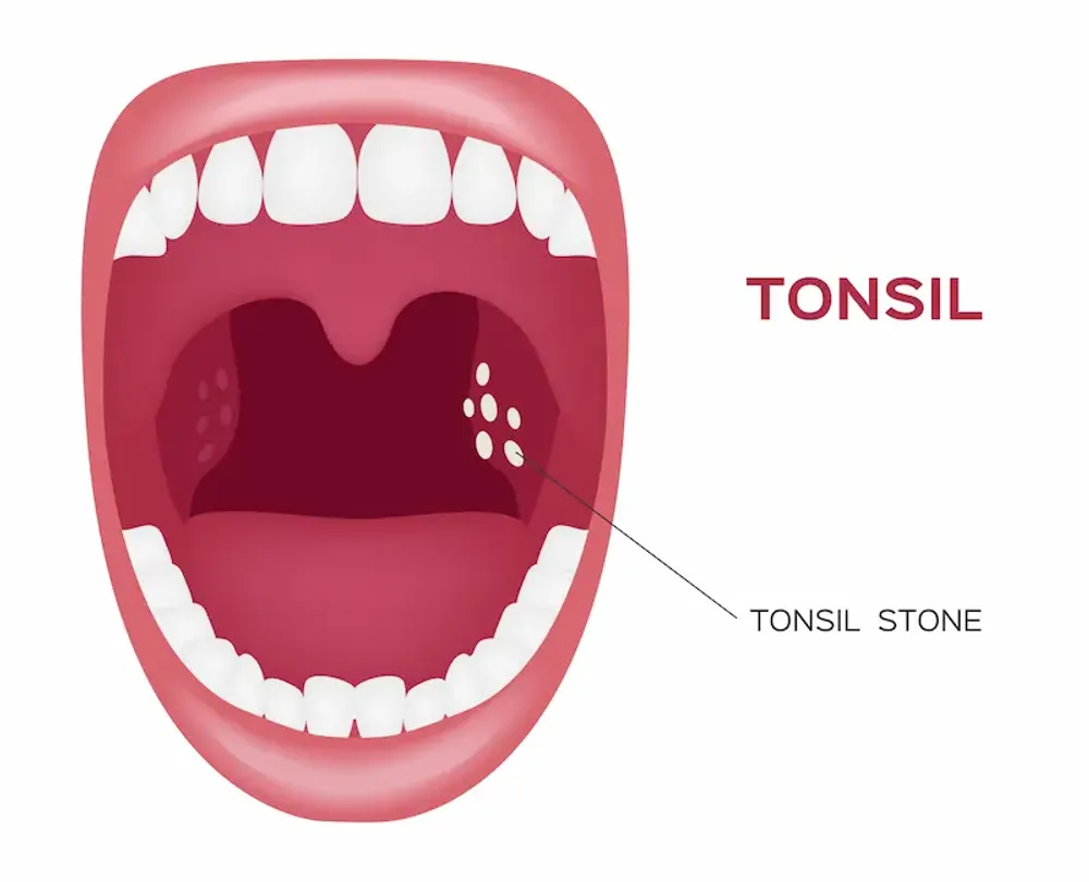 normal tonsil stones