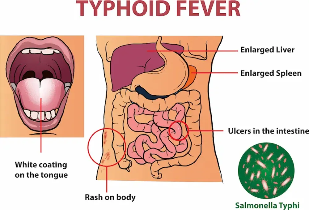 typhoid virus spread