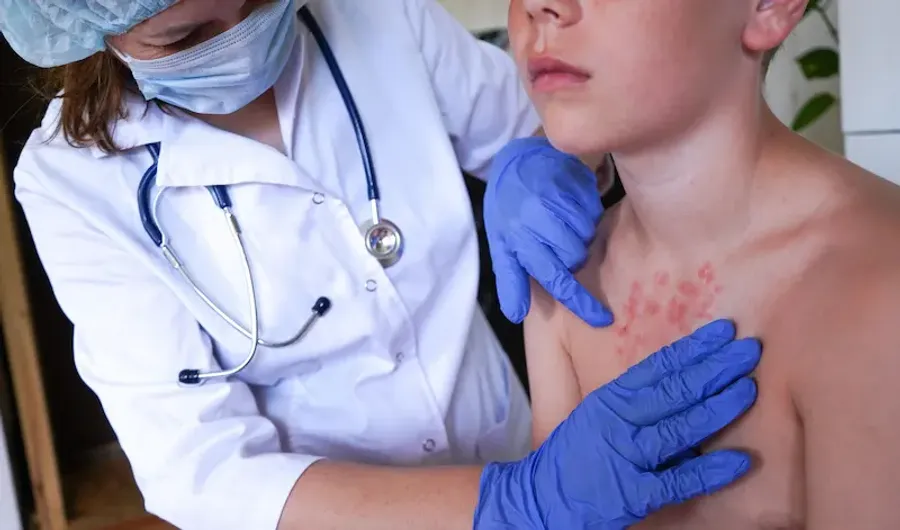Monkeypox Signs, Treatment, and Prevention A Complete Guide
